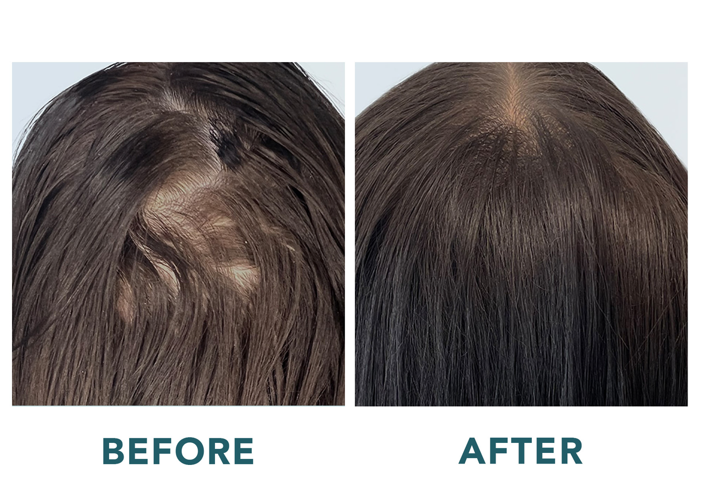 Advanced Scalp Serum | Clinically Proven Hair Growth